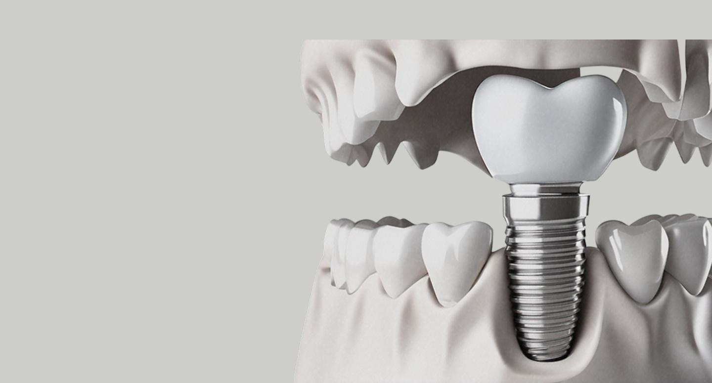 Get Surgical Guide for Dental Implants - Dental Implant Surgical Guide ...